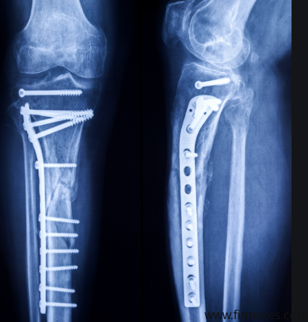 Research progress of surface modification of biomedical titanium alloy ...
