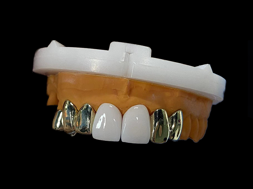 Full Cast CoCr Crown-Glisten