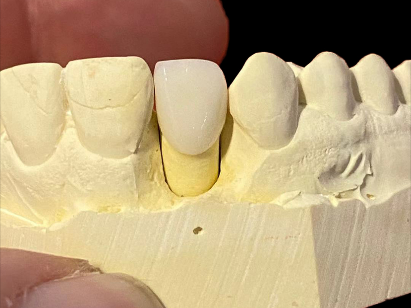 IPS e.Max® Press Veneer-Glisten