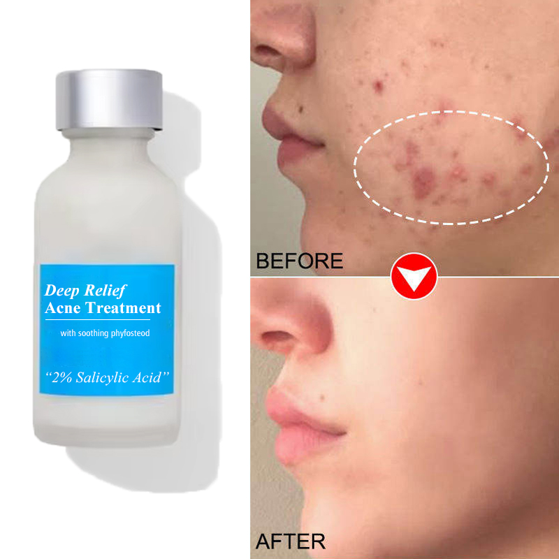 2% Salicylic Acid Acne Repair Face Serum - Professional Skincare for ...